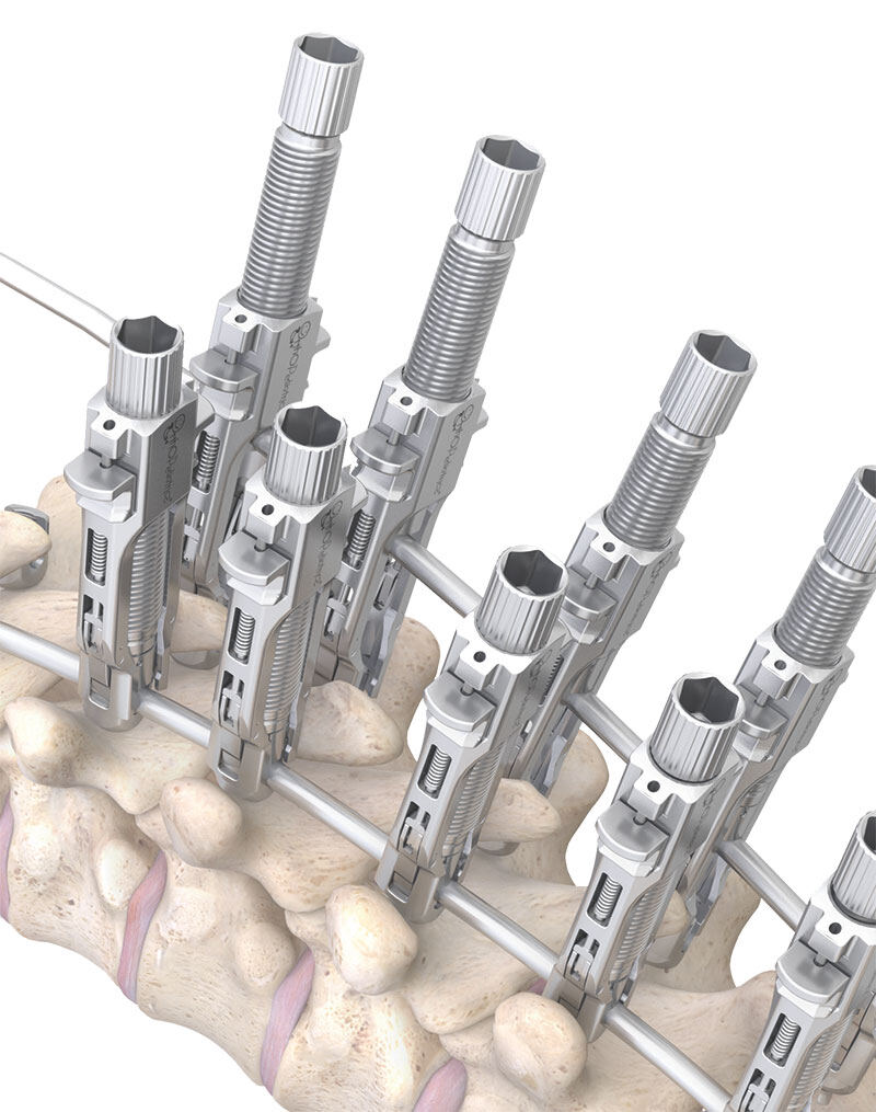 世界唯一：OrthoPediatrics独领儿童骨科矫形器械市场-动脉网
